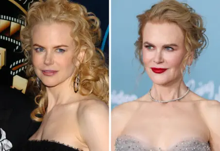 Nicole Kidman Plastic Surgery Before And After Pictures