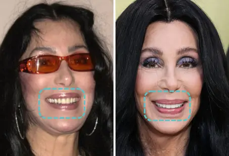 Cher Plastic Surgery: How The Goddess Of Pop Changed