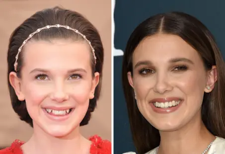 Has Millie Bobby Brown Had Plastic Surgery? | Longevita