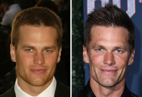 Tom Brady Plastic Surgery: Is It Real? | Longevita