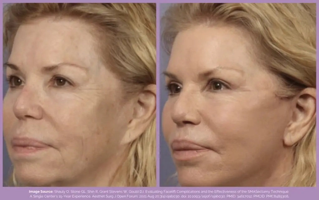SMAS Facelift: Procedure, Cost & Results | Longevita
