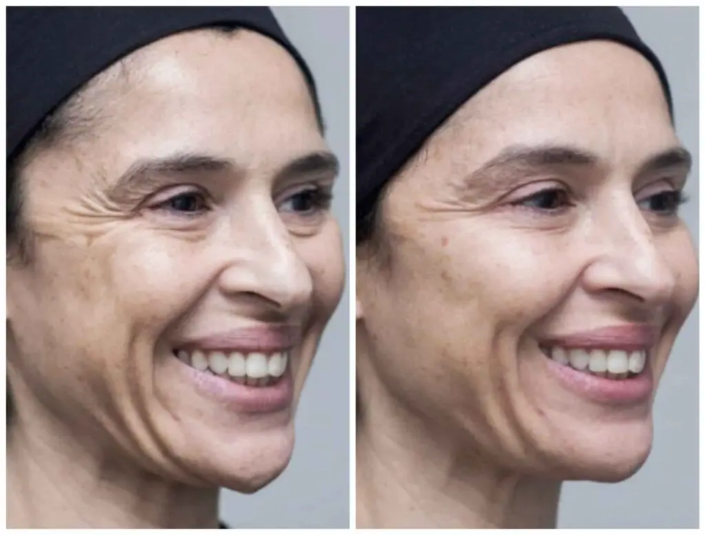 Cheek Fillers: Benefits, Results, & Cost | Longevita