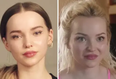 Dove Cameron Plastic Surgery: Did It Happen? | Longevita